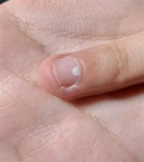 손톱에 하얀점 지식in