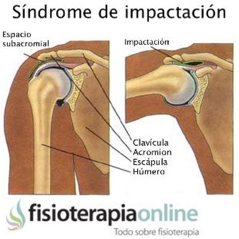 Síndrome De Pinzamiento Del Hombro Slbgr