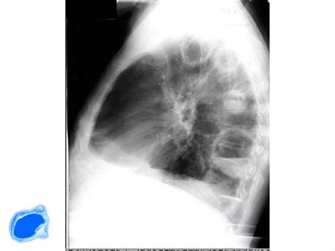 Cxr Cavity In Lung Ppt