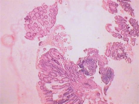 Colonic Biopsy What To Look For
