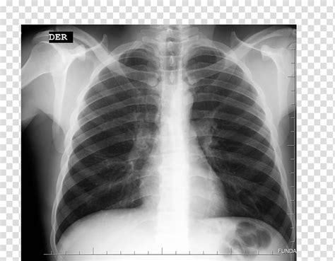 Free Download X Ray Radiology Radiography Rib Medical Imaging Ylang