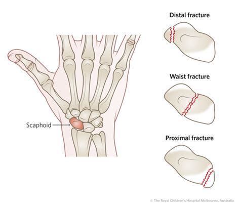 Scaphoid Fracture Classification
