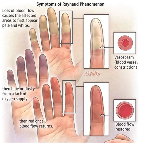 Raynauds Symptoms Diagram Aanda Podiatrists And Chiropodists