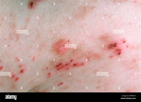 PRURITIC RASH Stock Photo Royalty Free Image 31078449 Alamy