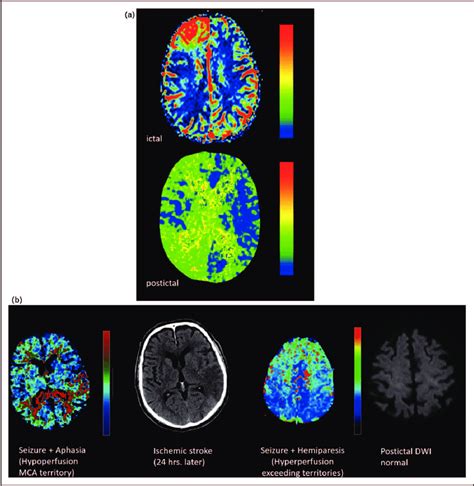 A Exemplary Perfusion Maps For Ictal Hyperperfusion Cerebral Blood