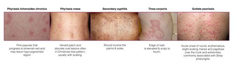 Viral Pharyngitis Rash