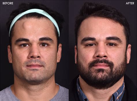 Face And Scalp Lipoma Treatment Facial Plastic Surgery Atlanta Ga