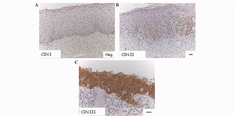 Cervical Intraepithelial Neoplasia In Pregnancy Interference Of