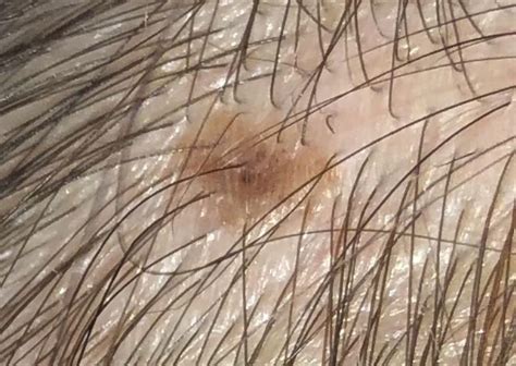 New Mole On Scalp About 5mm Wide Should I Be Worried R Melanoma
