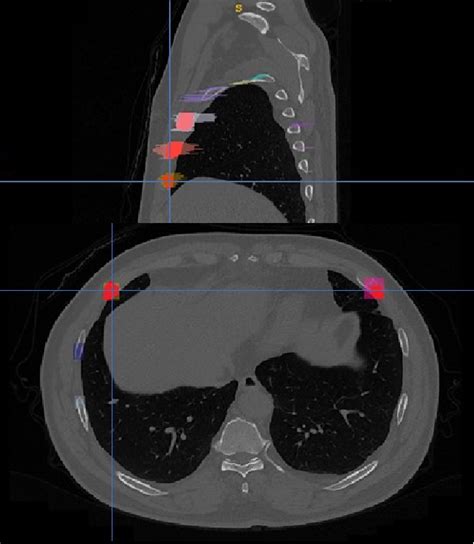 Figure 1 From Efﬁcient Object Detection In 3d Ct Scans Semantic Scholar