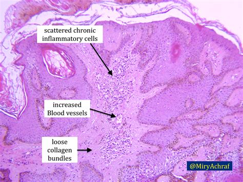 Fibroepithelial Polyp Histology