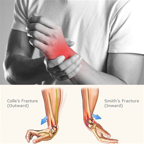 What Is A Smiths Fracture Tanya Coats Occupational Therapy