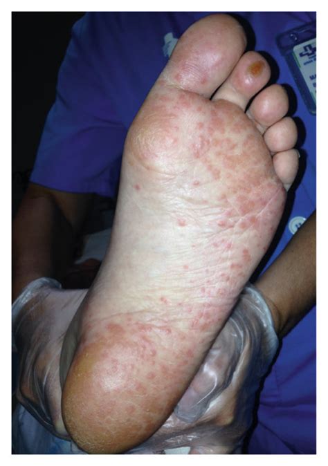Syphilis Maculopapular Rash