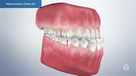 Class Iii Malocclusion Definition Feel Very Well Bloggers Picture Library