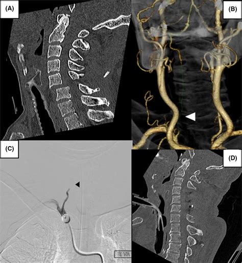 Ct And Dsa Results From Case 8 A Sagittal Plane Ct Scan Of Cervical