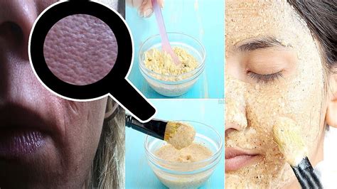 How To Get Rid Of Large OPEN PORES Permanently Top 5 Ways To Get Rid Of Large Pores YouTube