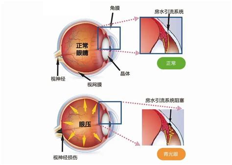 春季那些难缠的眼病最后一种还会致盲 知乎
