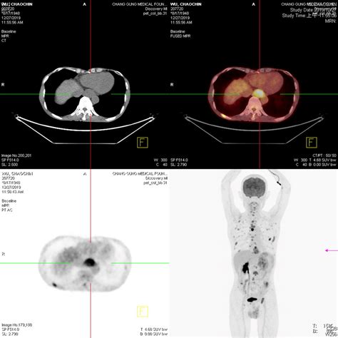 Tumor Scan Whole Body Tumor Scan From The Skull Vertex To Upper Thighs