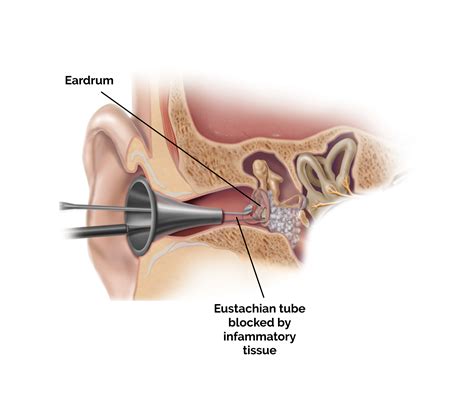 Tympanic Membrane Scarring Treatment