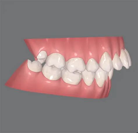 Invisalign Overbite Ruh Dental