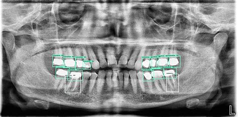 Improving Deep Learning Object Detection On Dental X Rays