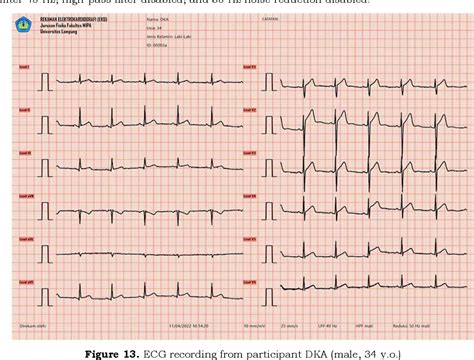 Figure 1 From Design Of Computer Based 12 Lead Ecg Using Stm32f401