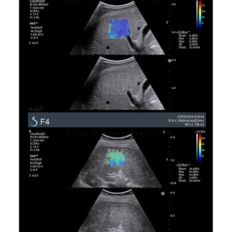 Pdf The Evaluation Of Liver Fibrosis In The Real Time Shear Wave Elastography Technique In