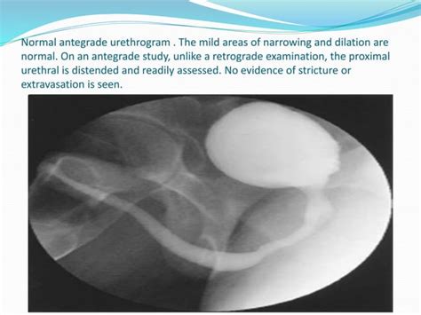 Antegrade And Retrograde Urethrogram Pptx Medical Tests Medical Health