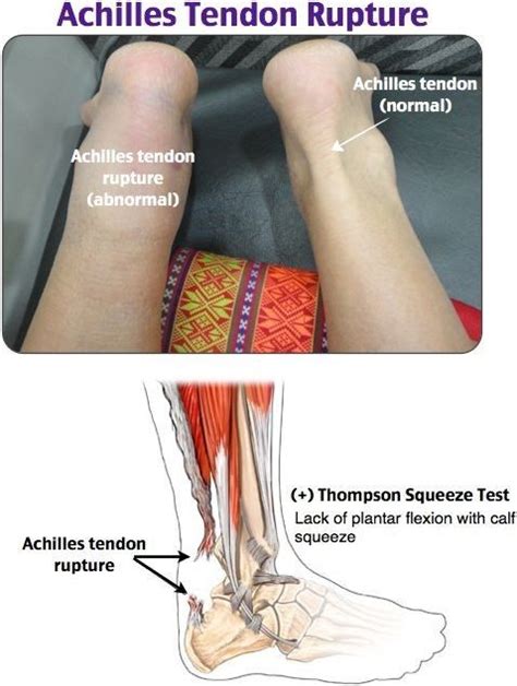A Sprained Ankle A Twisted Ankle And A Rolled Ankle What Is The