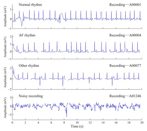 The George B Moody Physionet Challenge Matlab And Simulink