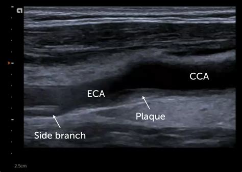 8 Eca Vs Ica External Versus Internal Carotid Artery 123 Sonography