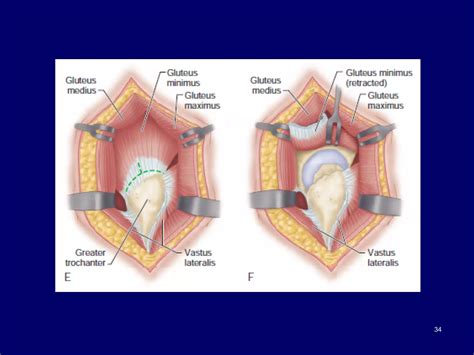 Hip Arthroplasty Approach Pdf