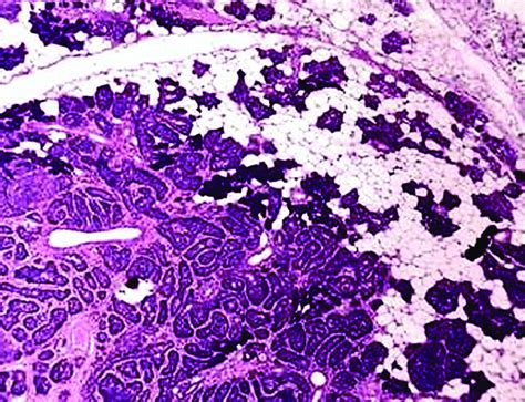 Isomorphic Cells Similar To Basaloid Cells With Palisading Arrangement