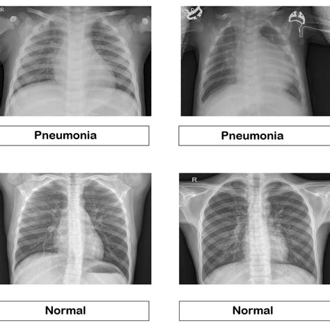 Chest Radiograph Images Pneumonia And Normal Kaggle