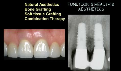Horizontal Bone Augmentation Using Bone Grafts And Resorbable Membranes Videdental