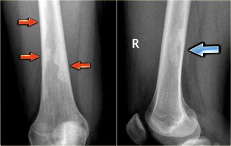 Ossifying Fibroma Femur