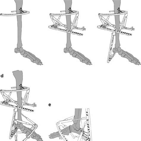 Pdf Taylor Spatial Frame In Severe Foot Deformities Using Double