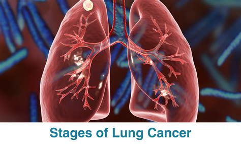 Stages Of Lung Cancer Apollo Hospitals Blog
