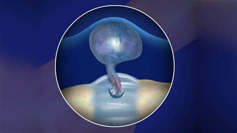 Ganglion Cyst Removal California Orthopaedic Specialists