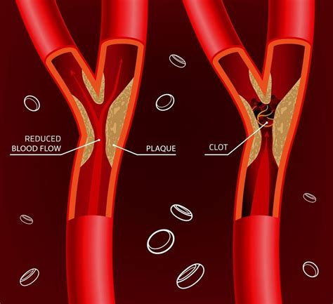 Leg Claudication And Exercise Everyone Is Guessing Including Your Doctor And Vascular Surgeon