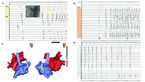 Trigger Sites Of Adenosine Induced Atrial Fibrillation And Recurrence Download Scientific