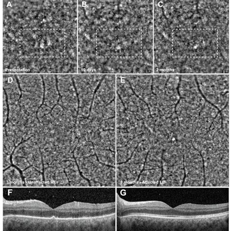 Tissue Architecture Improvement With Adaptive Optics The Top 3 Squares