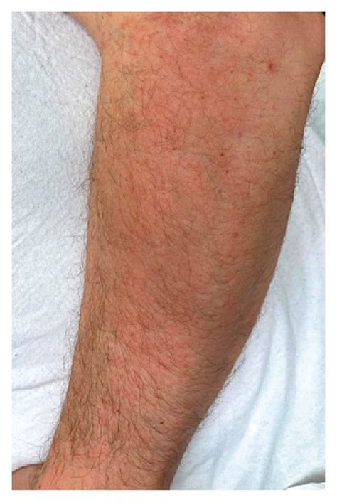 Pink Papules Coalescing Into Plaques On The Left Forearm The Rash Download Scientific Diagram