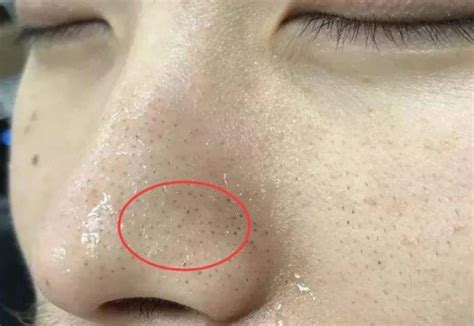 鼻子上的螨虫螨虫怕什么 伤感说说吧