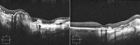 Octcases Uveitis Case 13