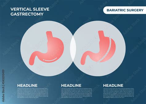 Laparoscopic Sleeve Gastrectomy Vertical Gastrectomy Weight Loss Surgery Vector Illustration