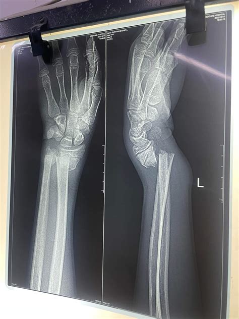 I Broke My Wrist R Brokenbones