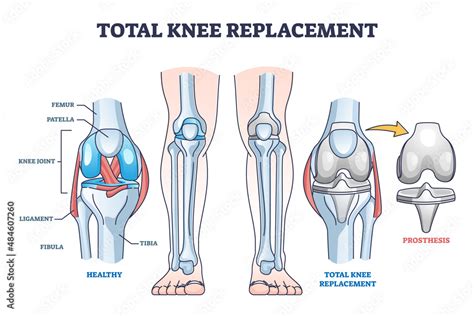 Total Knee Replacement Surgery And Prosthesis Operation Outline Diagram