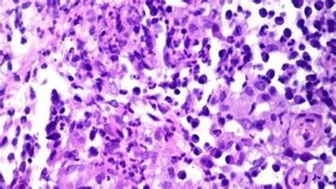 Reino Unido Preocupación Por La Bacteria Comecarne” Que Se Transmite