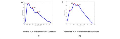 Icp Waveforms Abc Waves